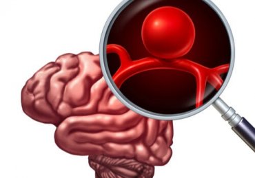 Intracranial Aneurysm - Brain - Exploring your mind